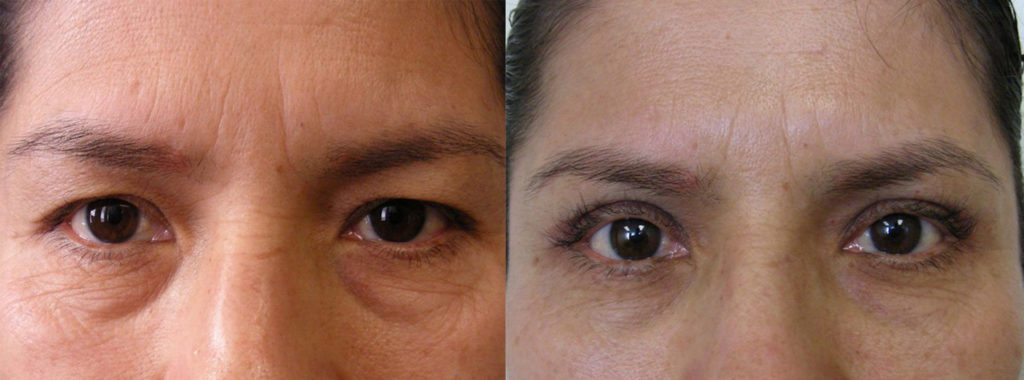 Blepharoplasty Pasadena | Eye Lift Pasadena | Cosmetic Surgery